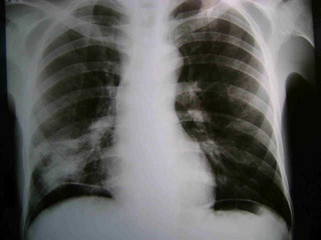 Quatre mois pour soigner la tuberculose latente - Afrique Sub-Saharienne
