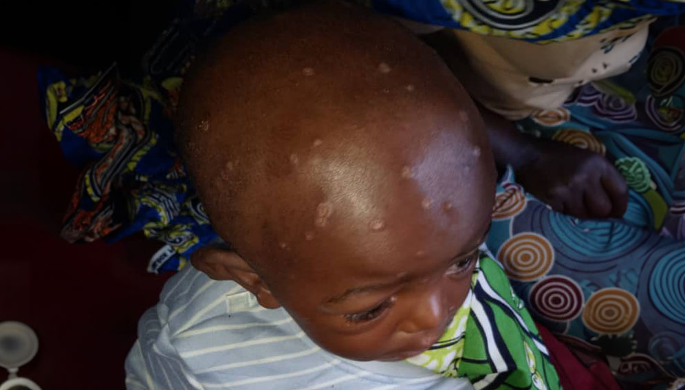 Mpox: still no jabs for ‘most at risk’ children in DRC
